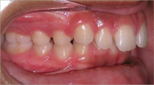 Deep Bite with Palatal Impingement