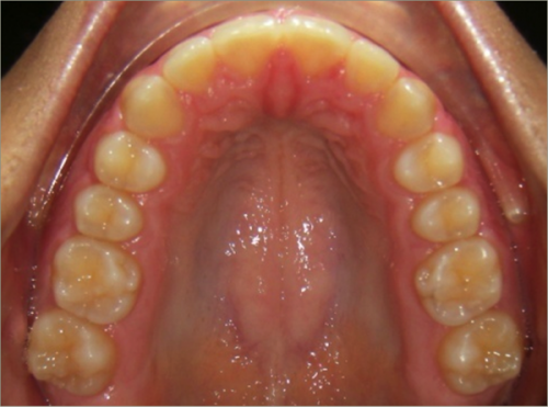 Deep Bite with Palatal Impingement