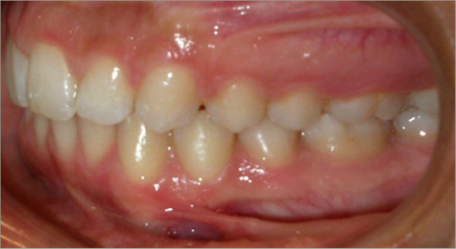 Deep Bite with Palatal Impingement