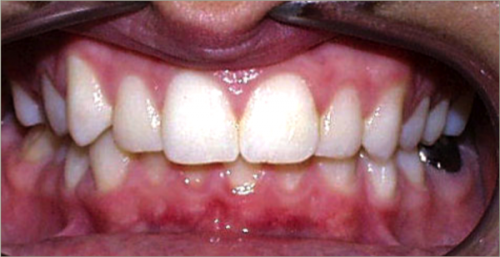 Deep Impinging Bite, Midline Asymmetry