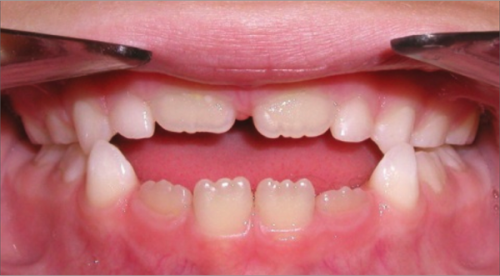 Open Bite Due to Thumb Habit